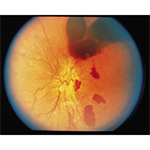 Treatment of Recurrent Corneal Erosions - American Academy of Ophthalmology